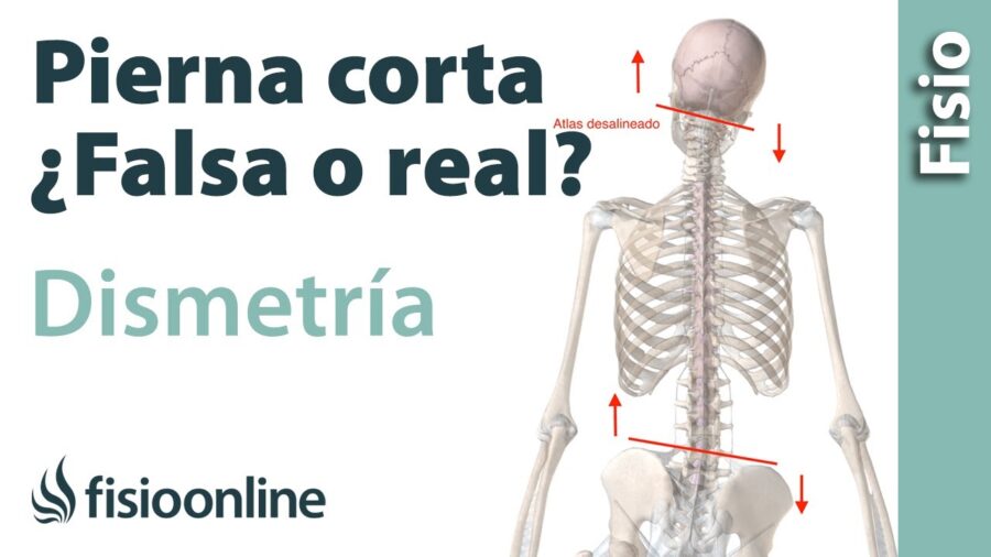 Dismetría O Pierna Corta - Ignesistraining.com
